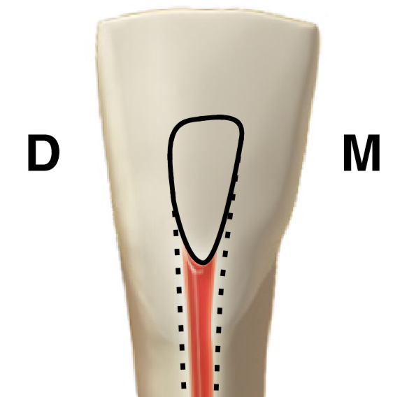 Outline Form Preparasi Akses Endodontik