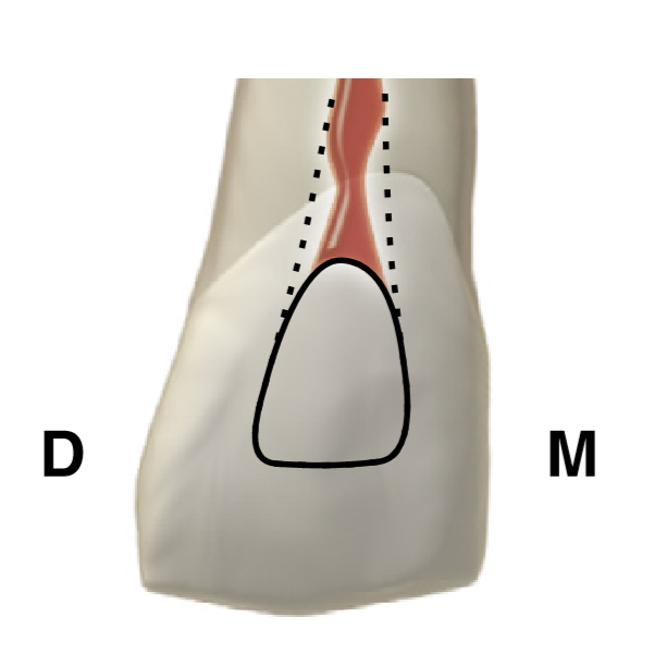 Outline Form Preparasi Akses Endodontik