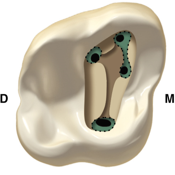 Outline Form Preparasi Akses Endodontik
