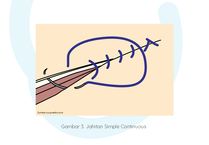 Macam-Macam Teknik Suturing