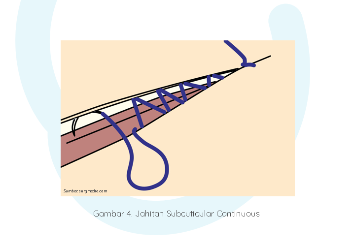 Macam-Macam Teknik Suturing