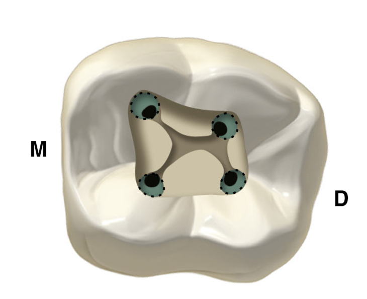 Outline Form Preparasi Akses Endodontik