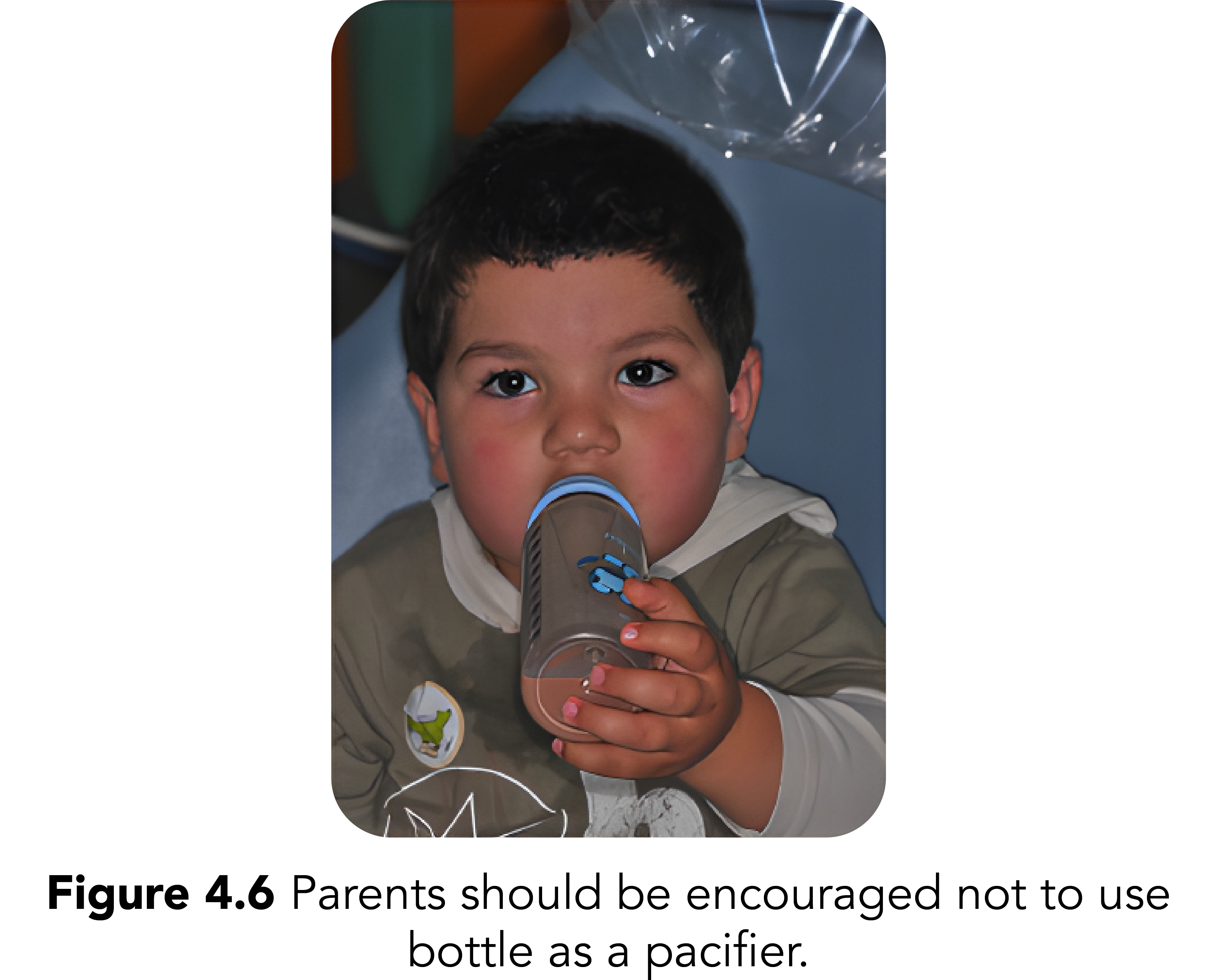 Karies pada Anak: Rampan Karies, Karies Botol dan Penyakit Periapikal ...