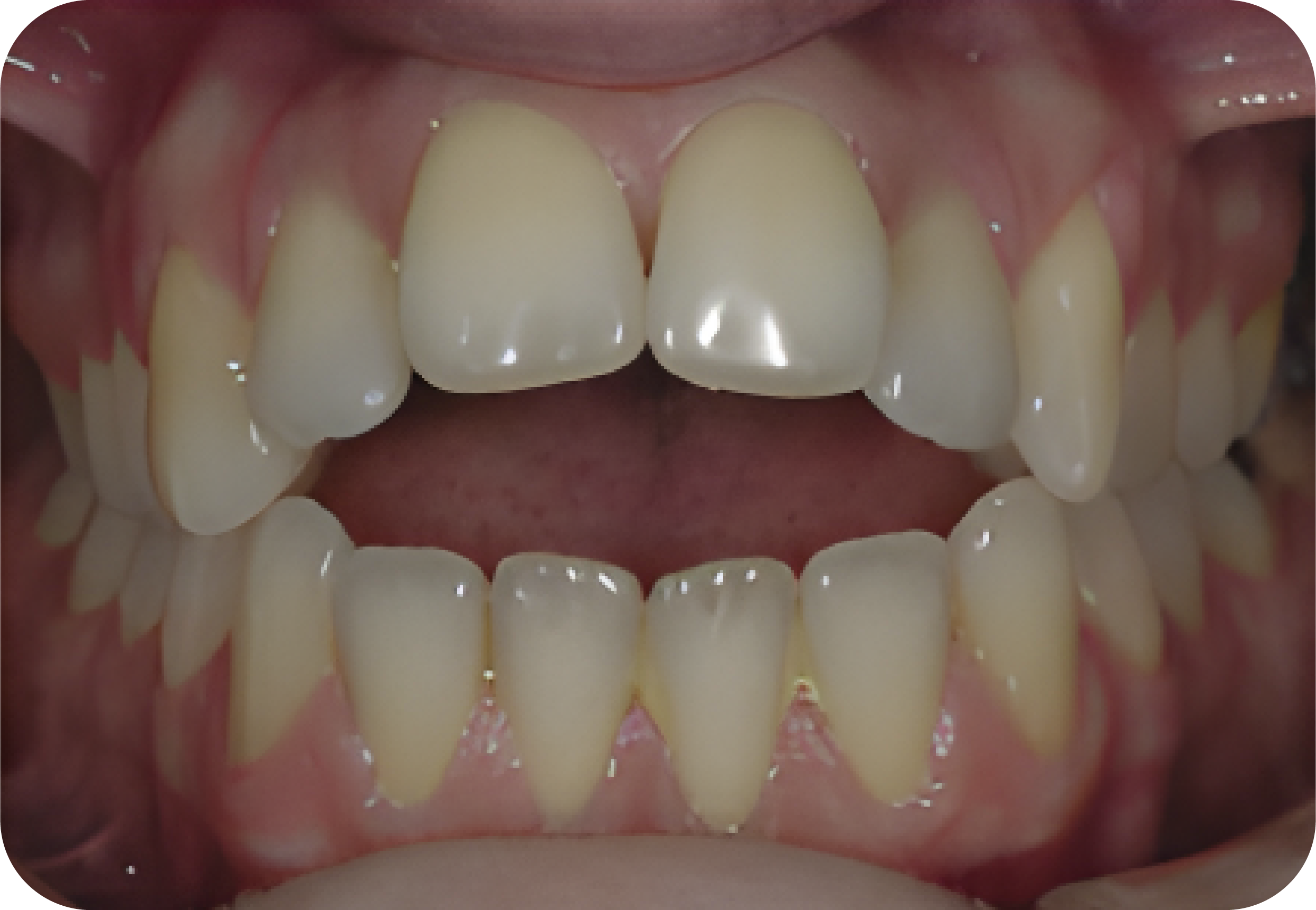 Analisis Gigi Geligi