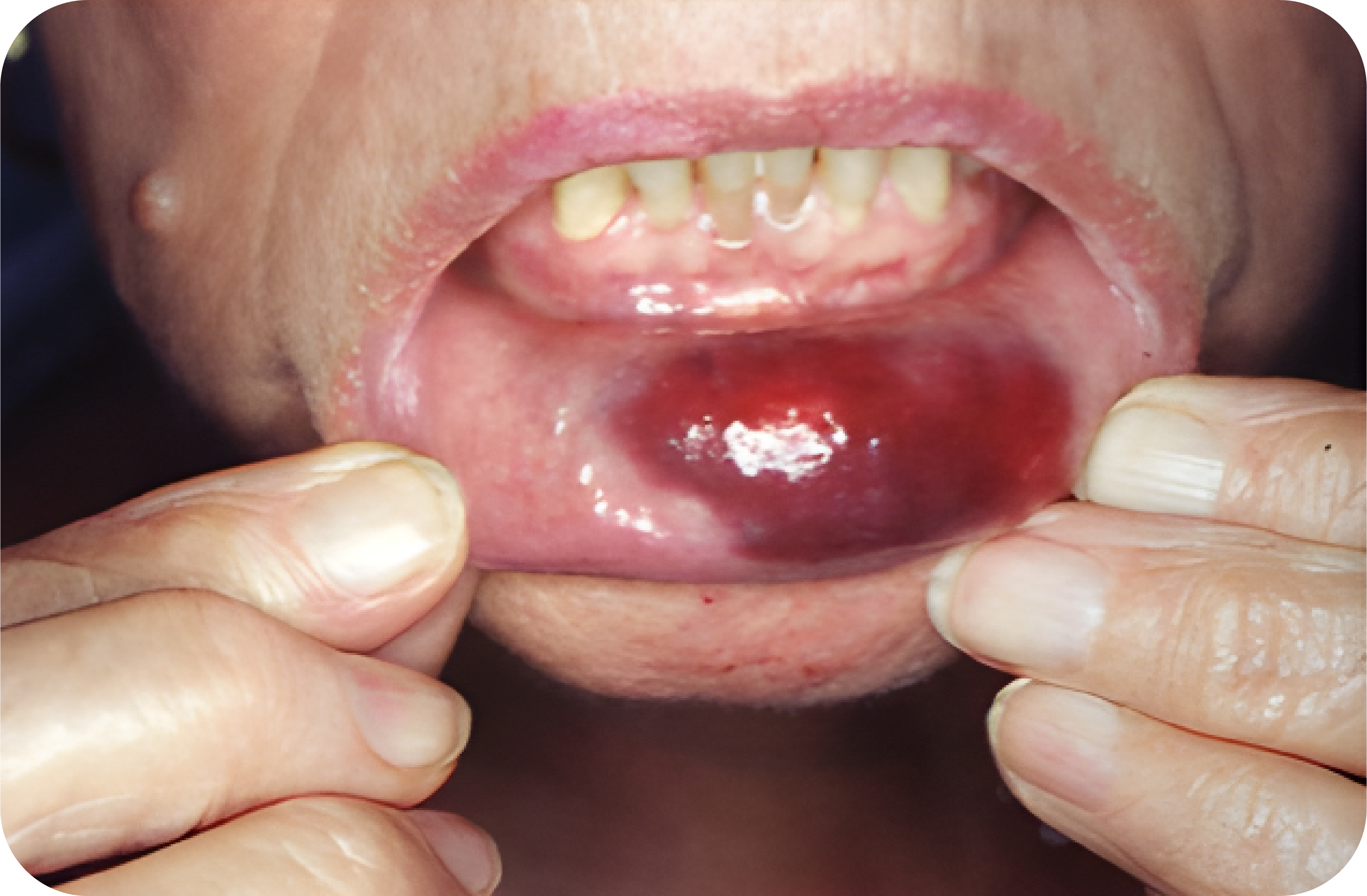 Oral Red and White Lession