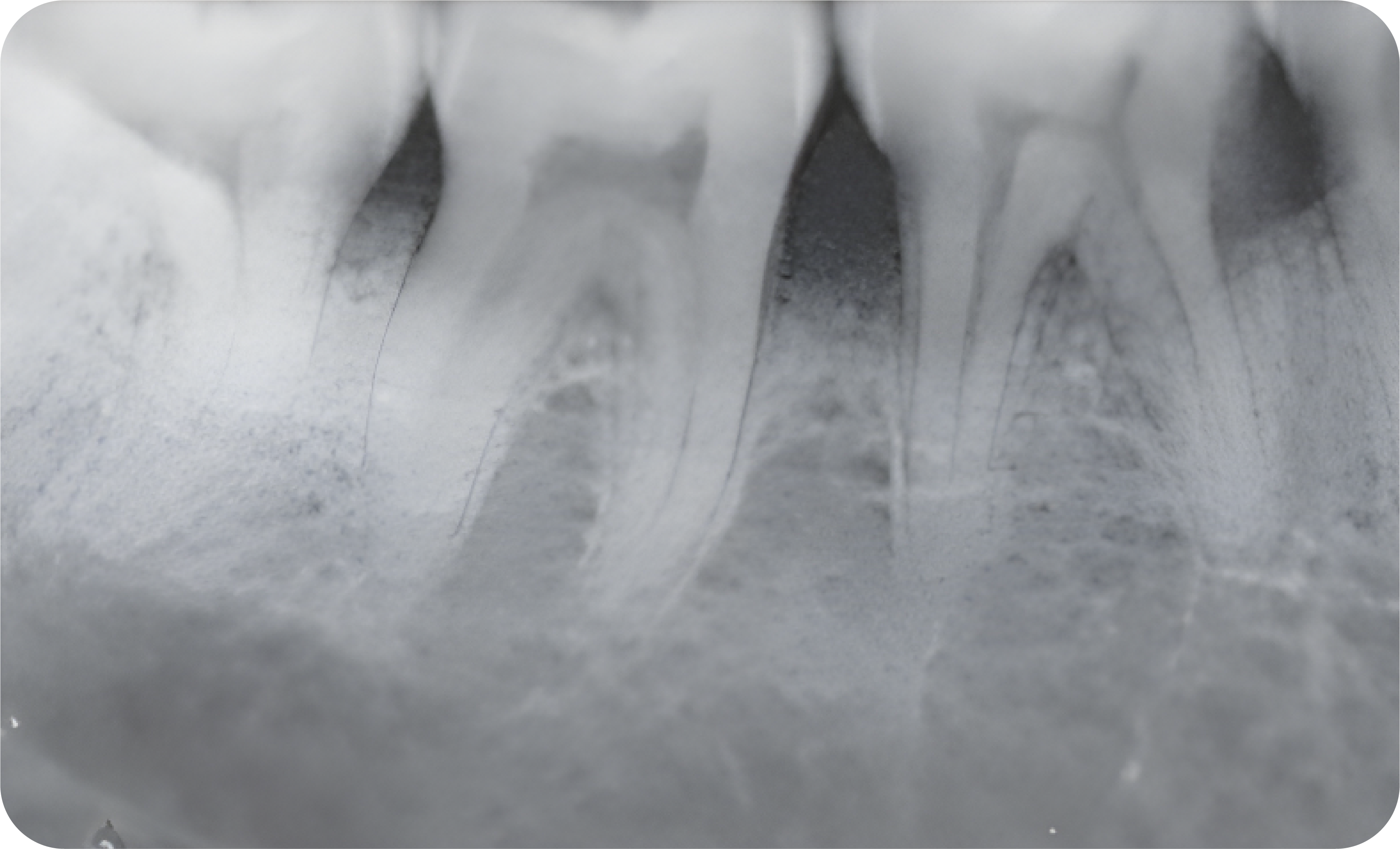 Kehilangan Tulang dan Destruksi / Bone Loss and Pattern of Bone Destruction