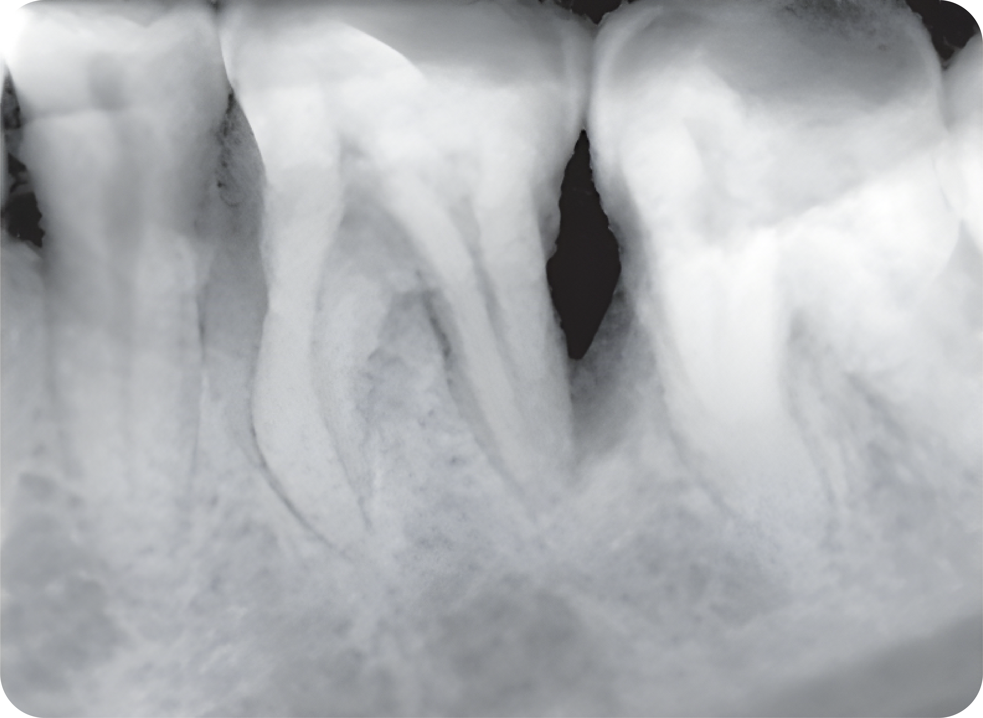 Kehilangan Tulang dan Destruksi / Bone Loss and Pattern of Bone Destruction
