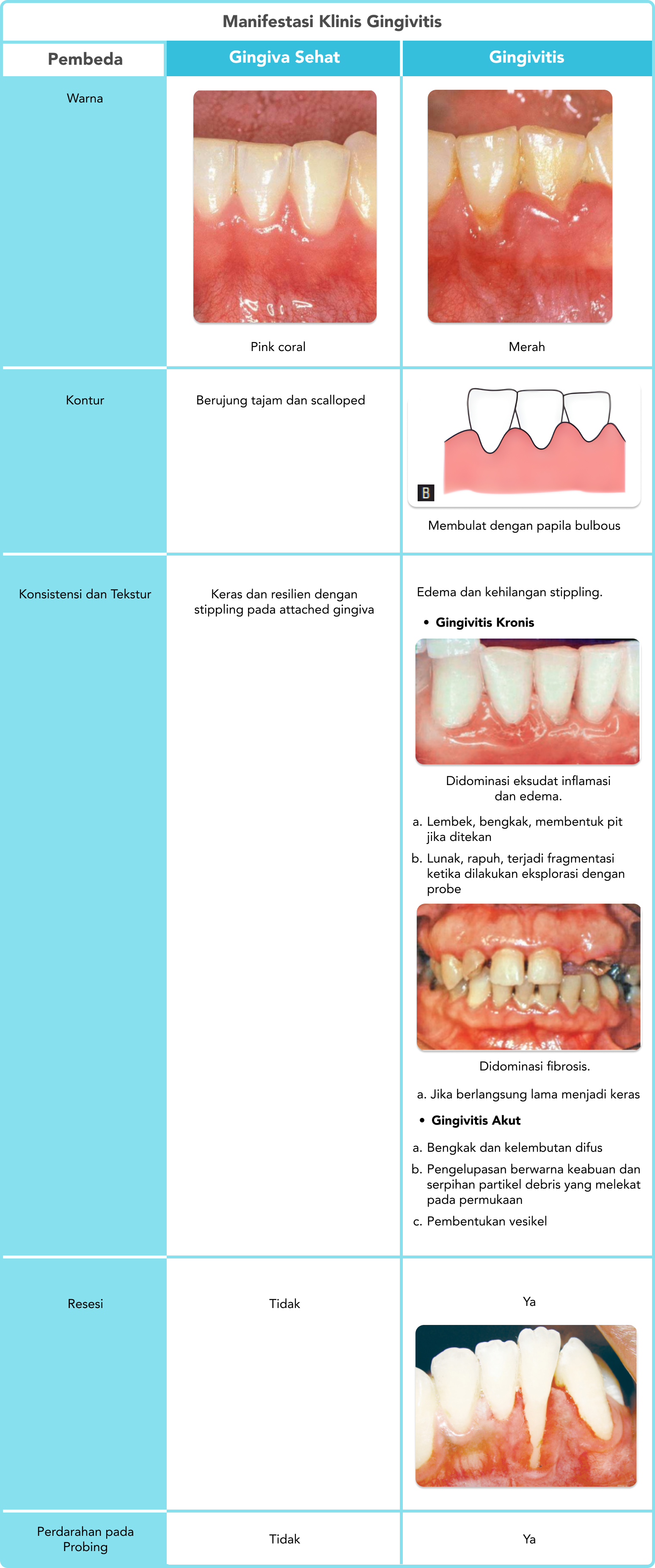 Gingivitis, Gingival Enlargement / Pembesaran Gingiva