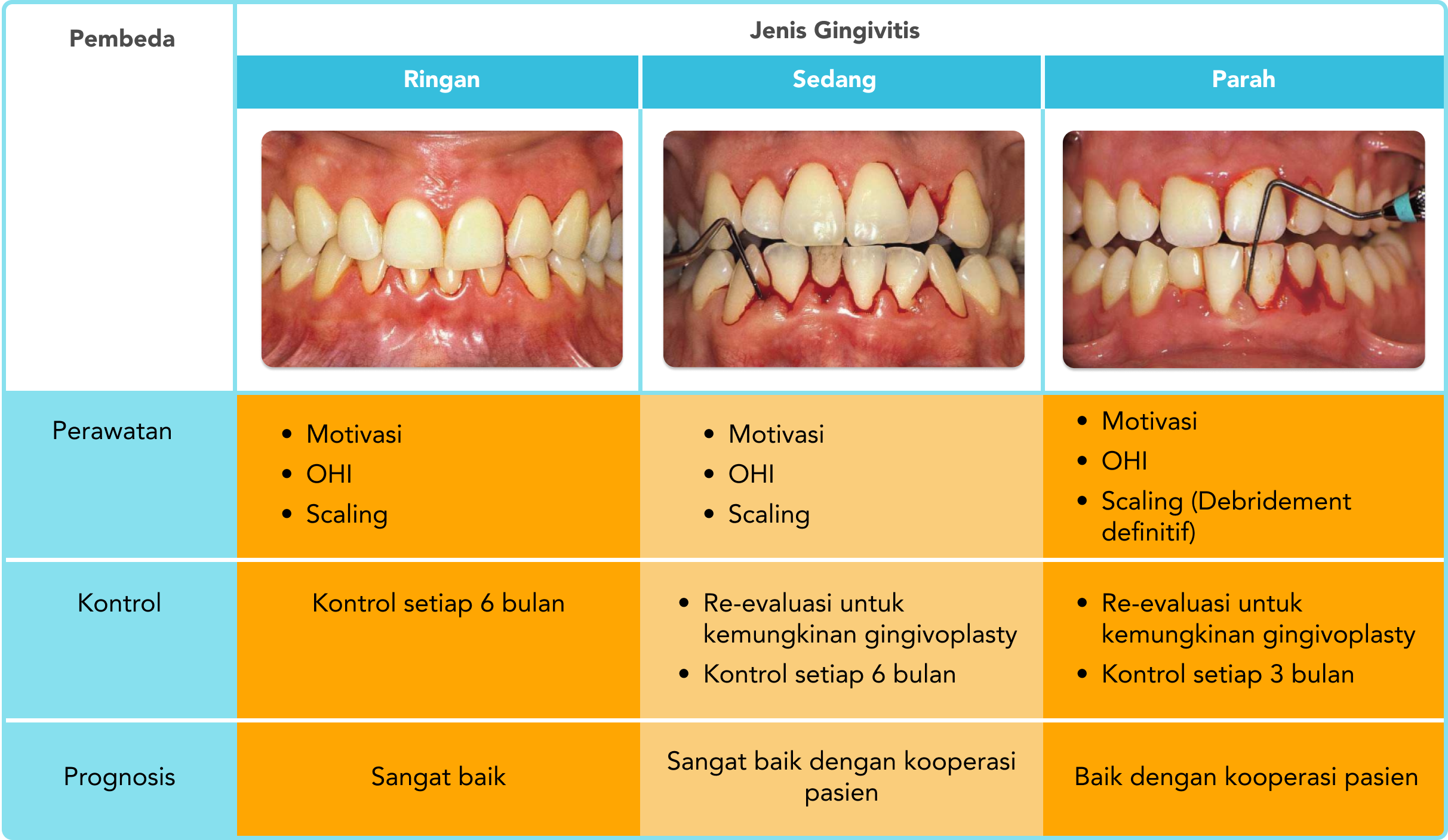 Gingivitis, Gingival Enlargement / Pembesaran Gingiva