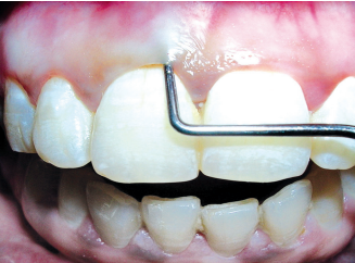 Flap dan Cangkok Gingiva