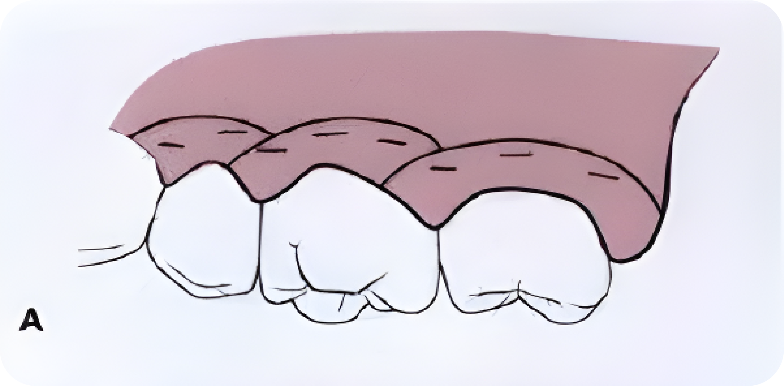 Gingivektomi, Gingivoplasty, dan Vestibuloplasty