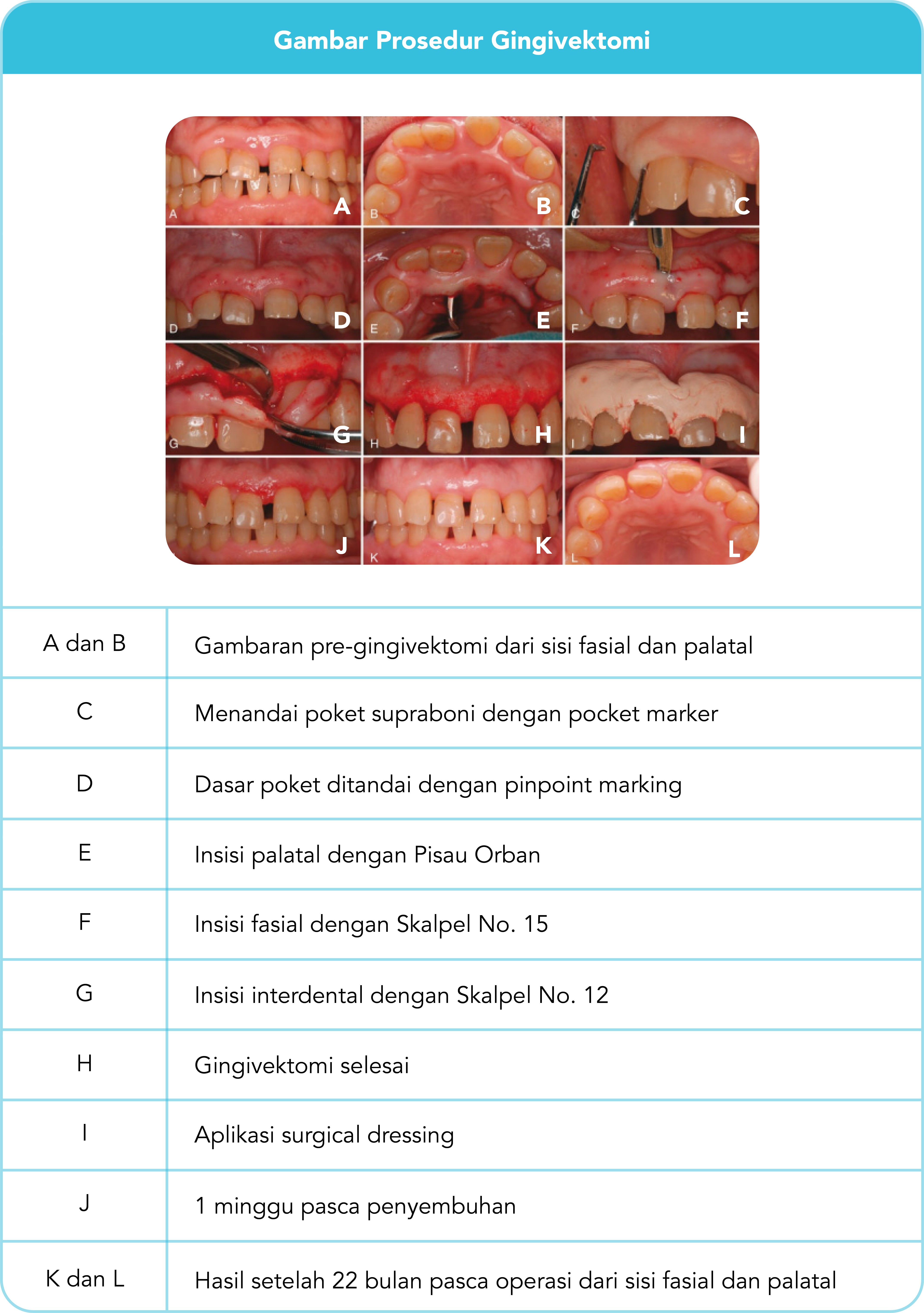 Gingivektomi, Gingivoplasty, dan Vestibuloplasty