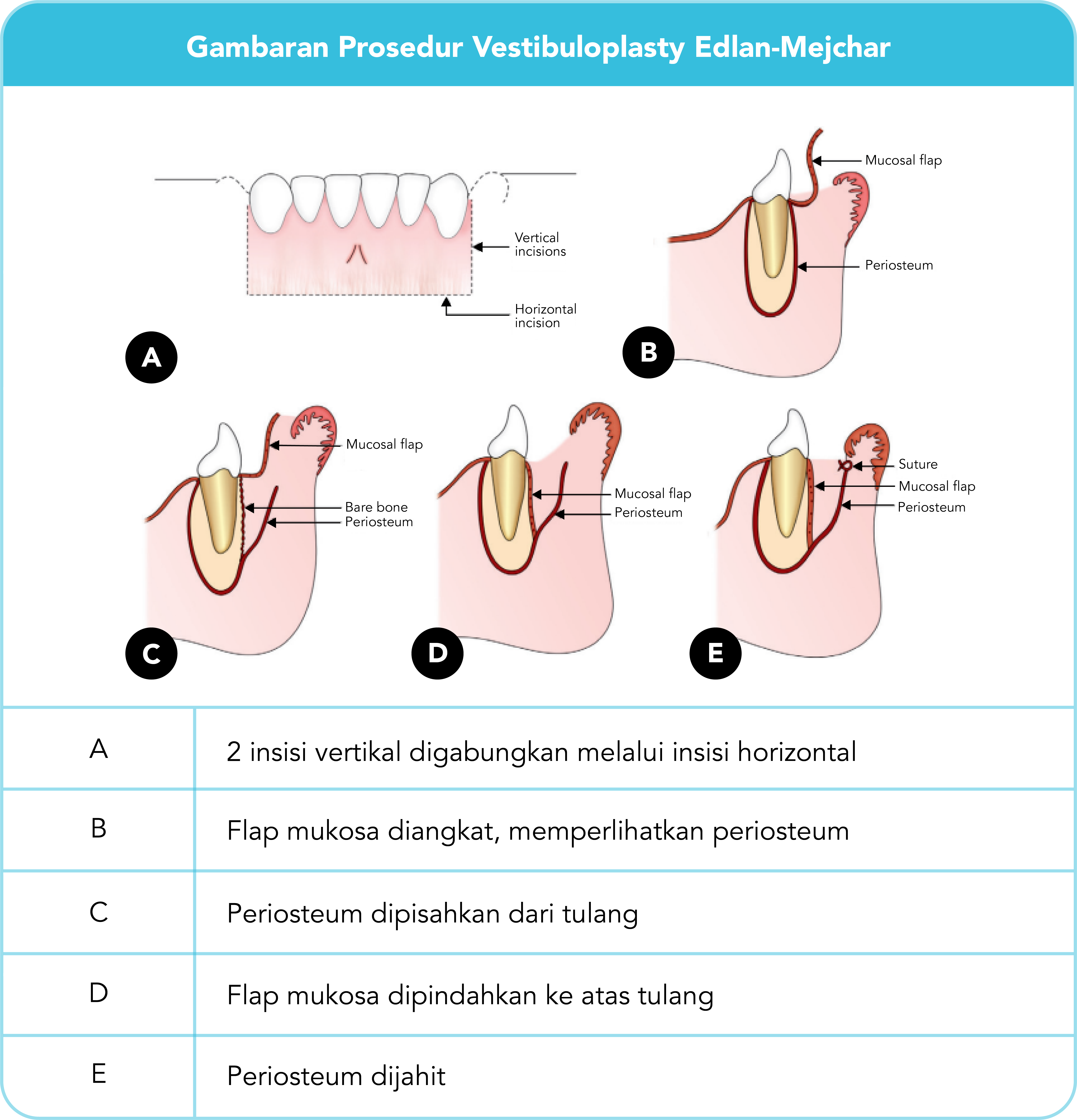 Gingivektomi, Gingivoplasty, dan Vestibuloplasty