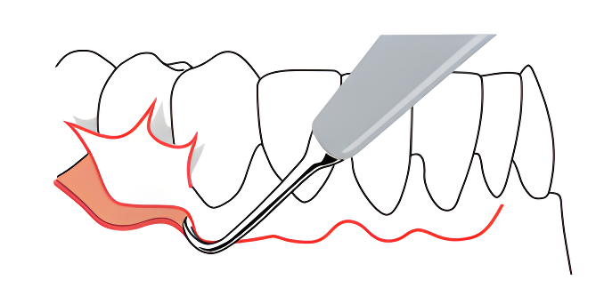 Gingivektomi, Gingivoplasty, dan Vestibuloplasty