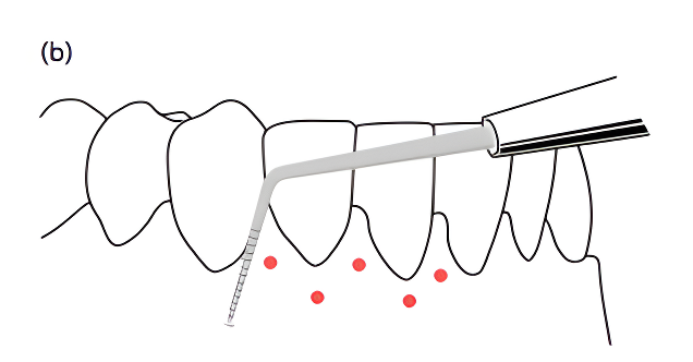 Gingivektomi, Gingivoplasty, dan Vestibuloplasty