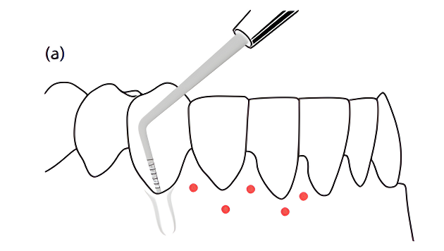 Gingivektomi, Gingivoplasty, dan Vestibuloplasty