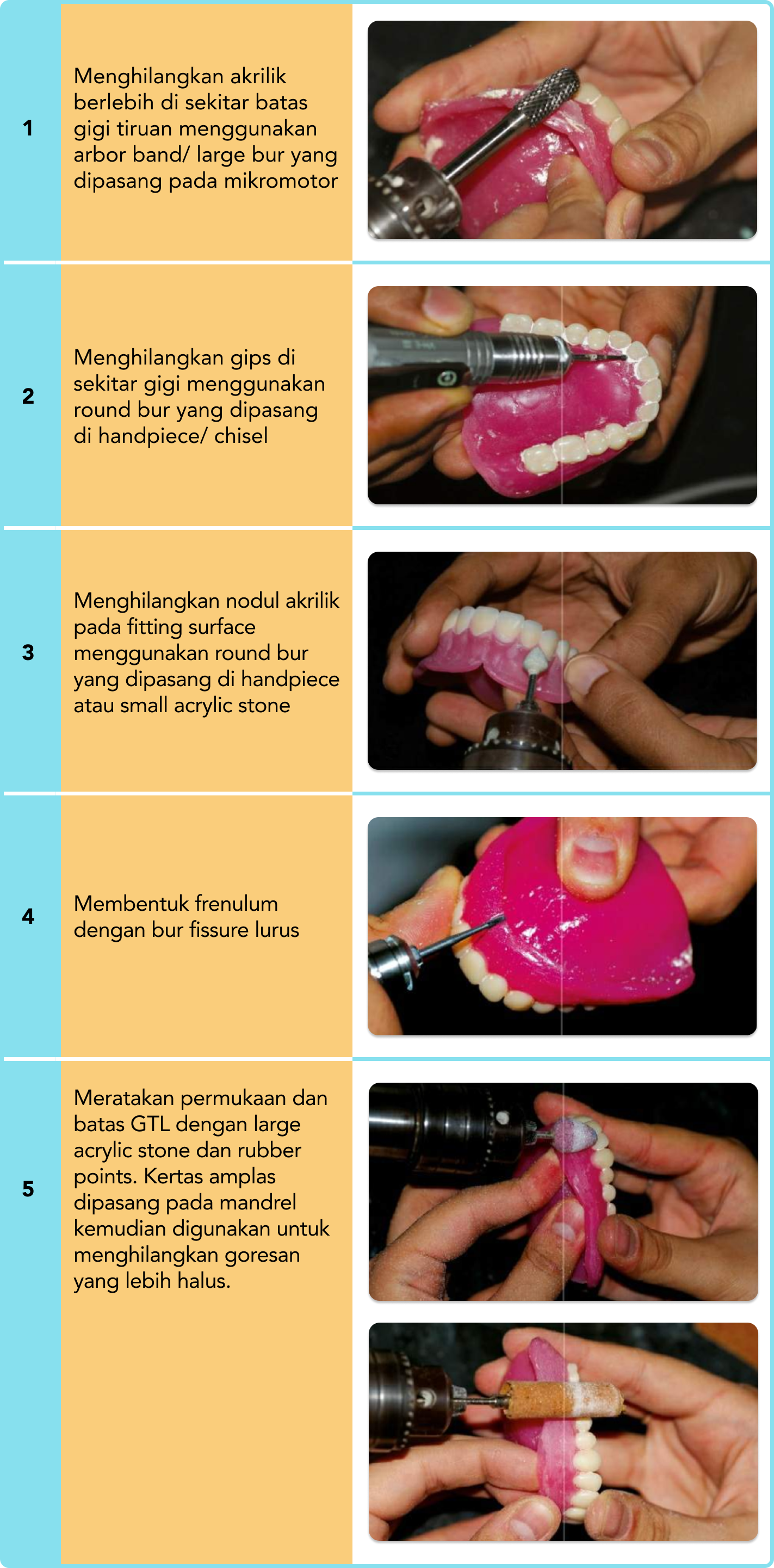 Pengenalan Gigi Tiruan Lengkap (Full Denture)