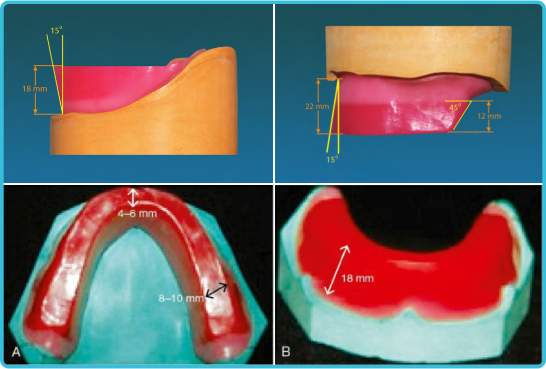 Pengenalan Gigi Tiruan Lengkap (Full Denture)