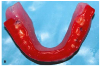 Insersi dan Penyesuaian Oklusi