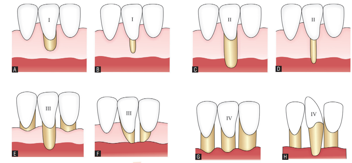 Lebih Paham tentang Penyebab dan Klasifikasi Resesi Gusi