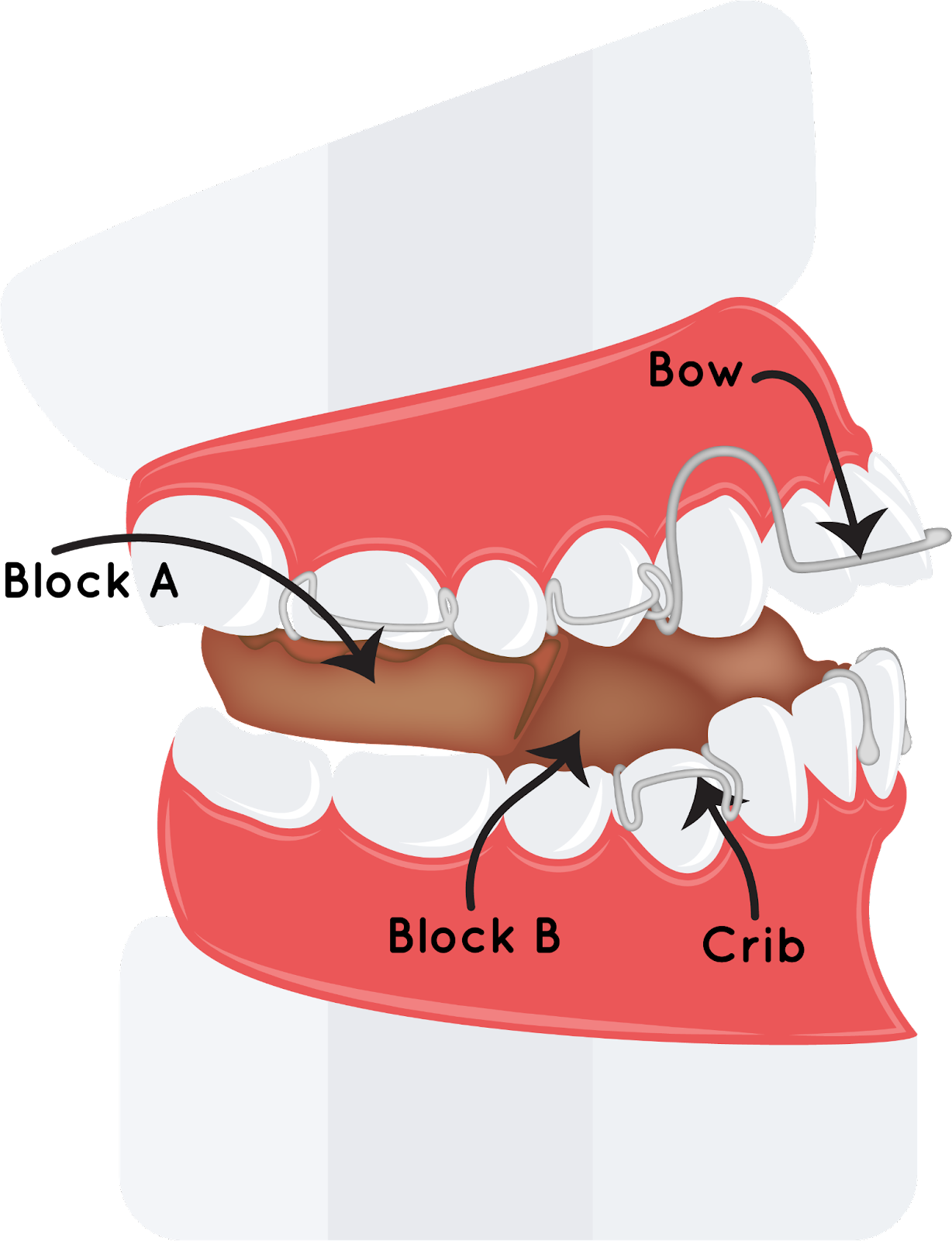 Komponen Aktif Dan Retentif Piranti Ortodonsi Lepasan