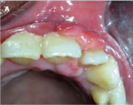 Gingival Enlargement