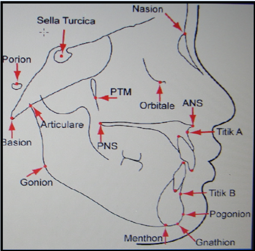 Analisis Sefalometri