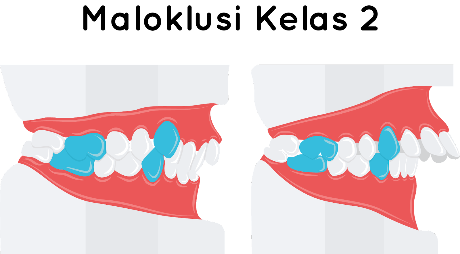 Diagnosis Maloklusi Dan Macam Perawatannya
