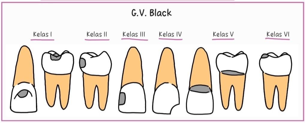 Restorasi Gigi Sulung