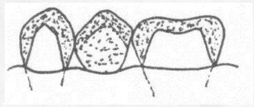 Gigi Tiruan Jembatan