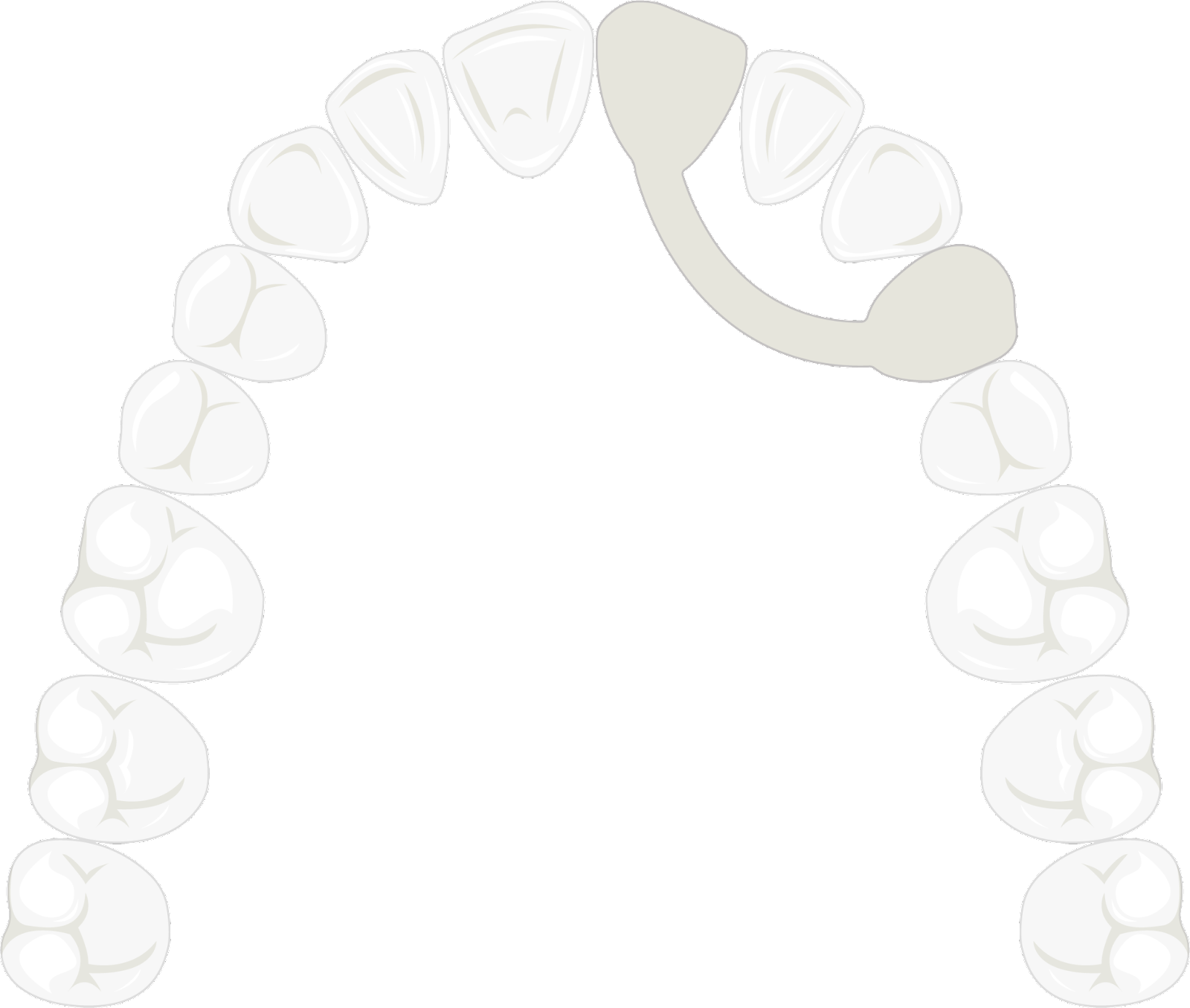 Gigi Tiruan Jembatan