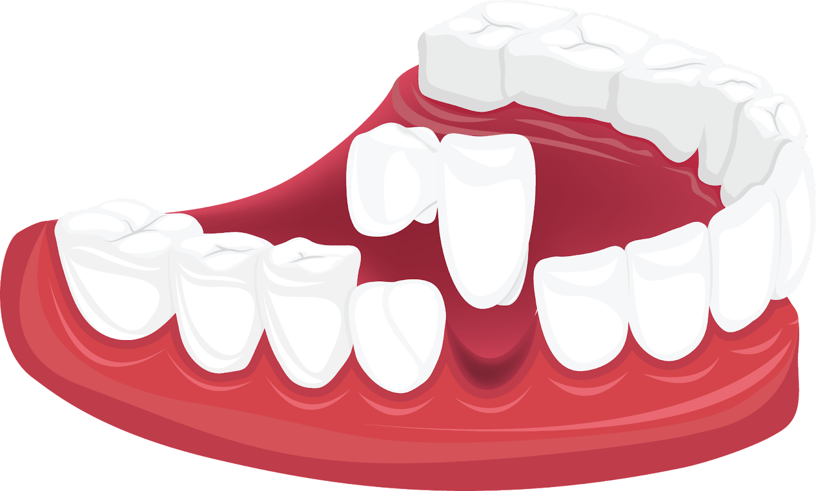 Gigi Tiruan Jembatan