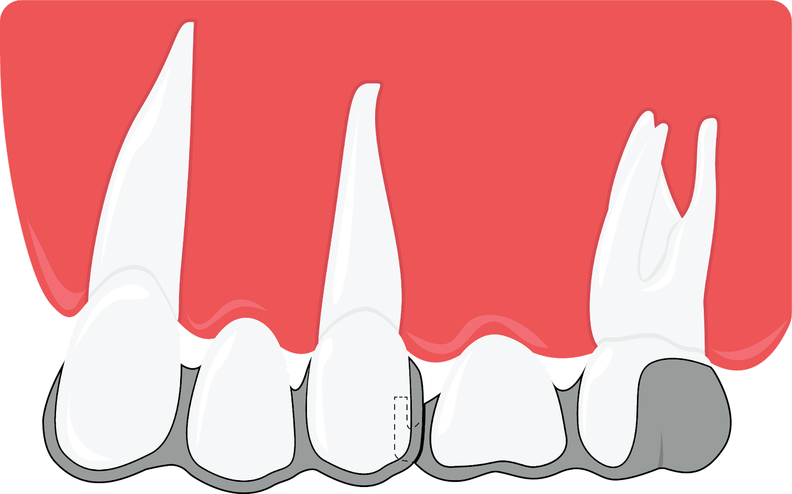 Gigi Tiruan Jembatan