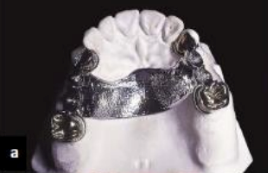 Gigi Tiruan Sebagian Lepasan Kerangka Logam