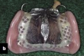 Gigi Tiruan Sebagian Lepasan Kerangka Logam