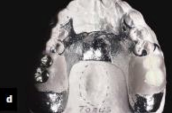 Gigi Tiruan Sebagian Lepasan Kerangka Logam