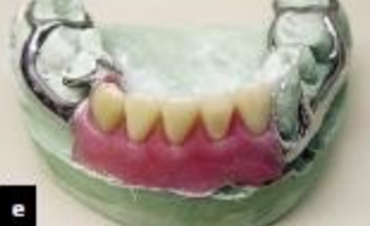 Gigi Tiruan Sebagian Lepasan Kerangka Logam