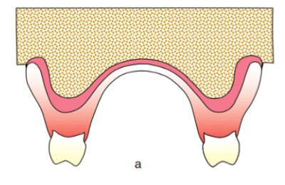 Relining Dan Rebasing