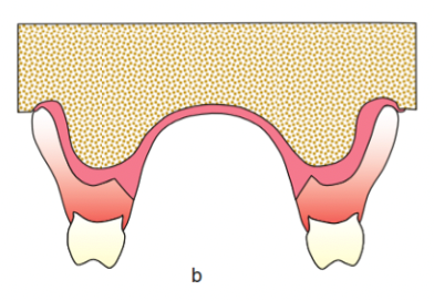 Relining Dan Rebasing