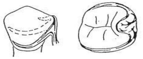 Gigi Tiruan Sebagian Lepasan Kerangka Logam