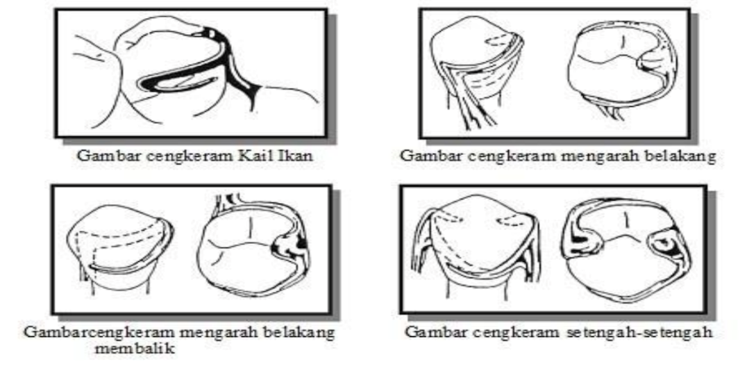 Gigi Tiruan Sebagian Lepasan Kerangka Logam