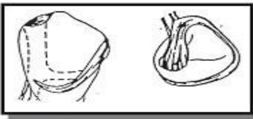 Gigi Tiruan Sebagian Lepasan Kerangka Logam