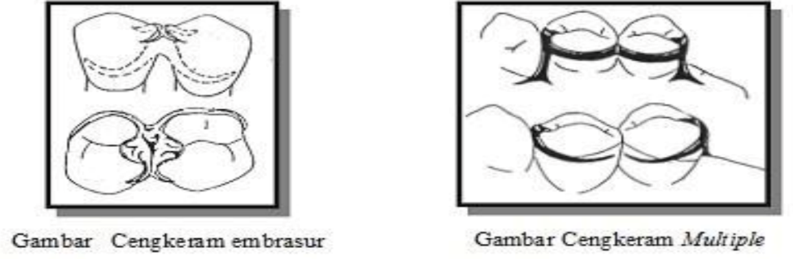 Gigi Tiruan Sebagian Lepasan Kerangka Logam