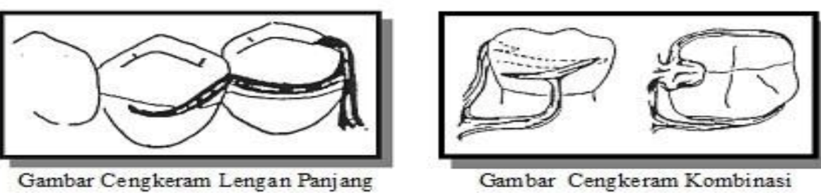 Gigi Tiruan Sebagian Lepasan Kerangka Logam