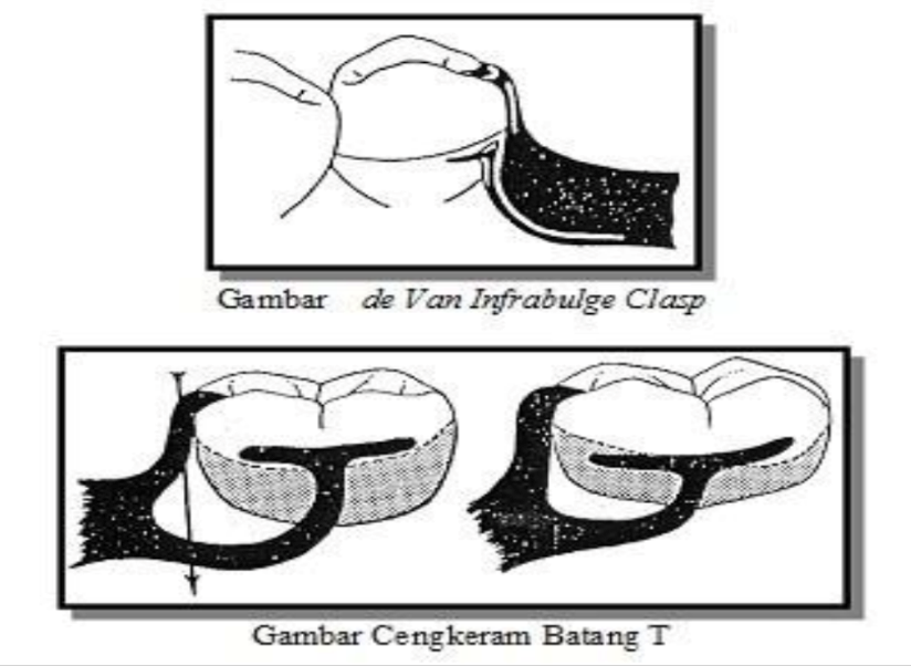 Gigi Tiruan Sebagian Lepasan Kerangka Logam