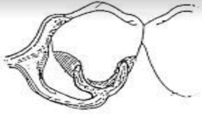 Gigi Tiruan Sebagian Lepasan Kerangka Logam