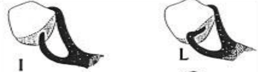 Gigi Tiruan Sebagian Lepasan Kerangka Logam