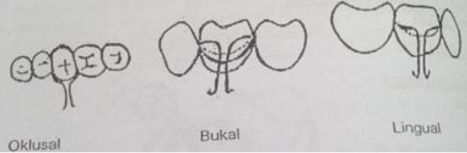 Gigi Tiruan Sebagian Lepasan (GTSL)