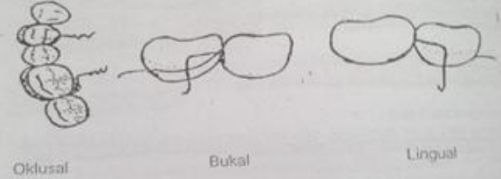 Gigi Tiruan Sebagian Lepasan (GTSL)