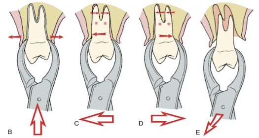 Ekstraksi Gigi Sulung